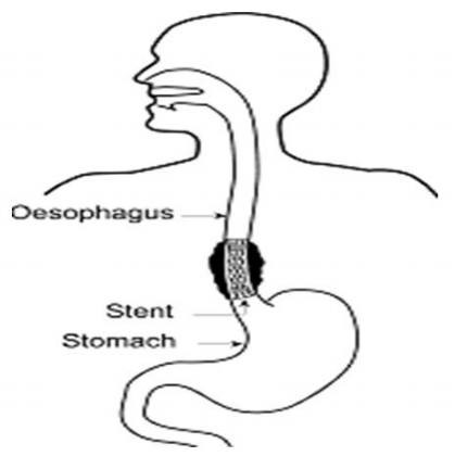 Oesophageal Stent Insertion — Chelsea and Westminster Hospital NHS ...