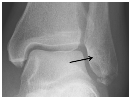 Ankle Injuries — Chelsea and Westminster Hospital NHS Foundation Trust
