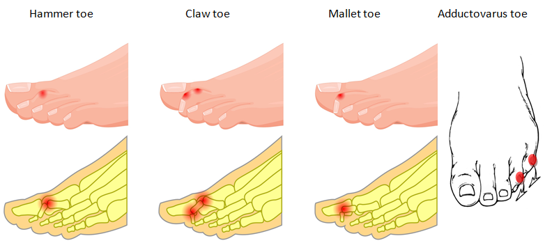ManagementofToeDeformities.PNG — Chelsea and Westminster Hospital NHS ...