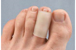 Management of Toe Deformities — Chelsea and Westminster Hospital NHS ...
