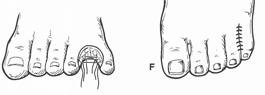 Metatarsalgiaanddislocatedtoedeformities7.jpg — Chelsea and Westminster ...