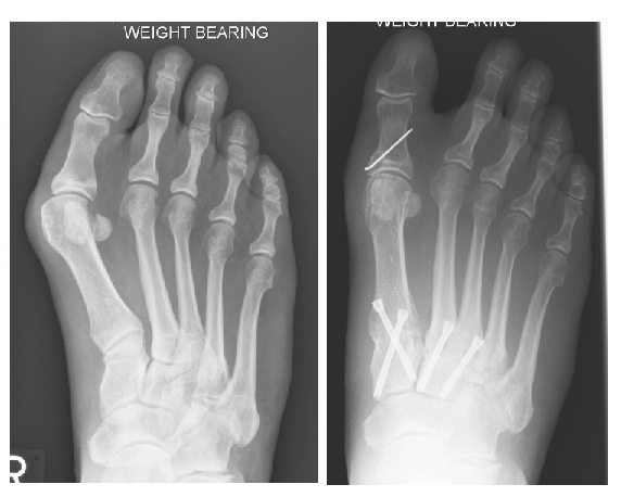 Midfootproblems10.PNG — Chelsea and Westminster Hospital NHS Foundation ...