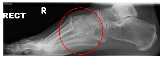 Midfootproblems5.PNG — Chelsea and Westminster Hospital NHS Foundation ...